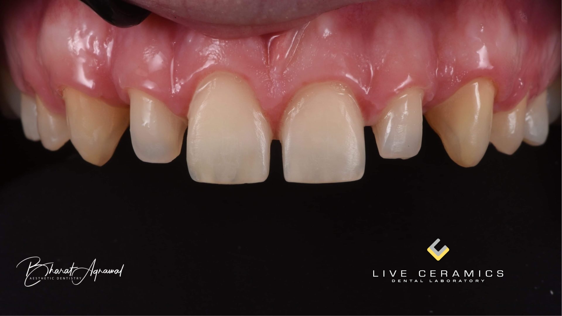 VENEER – Case 3 – Live Ceramics