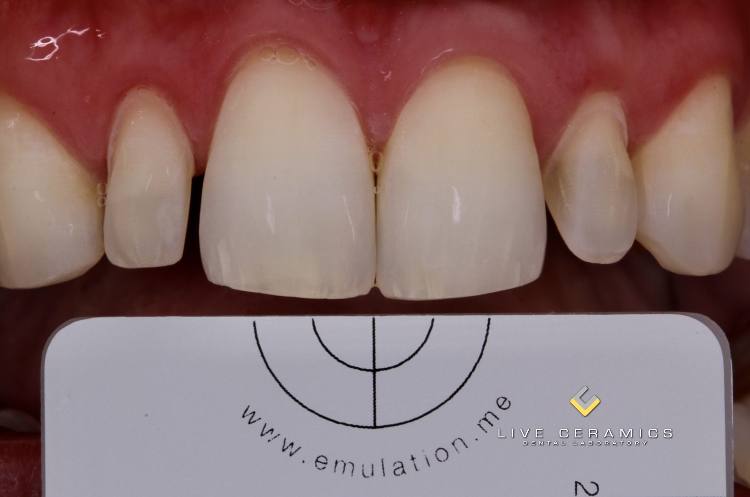 VENEER – Case 2 – Live Ceramics