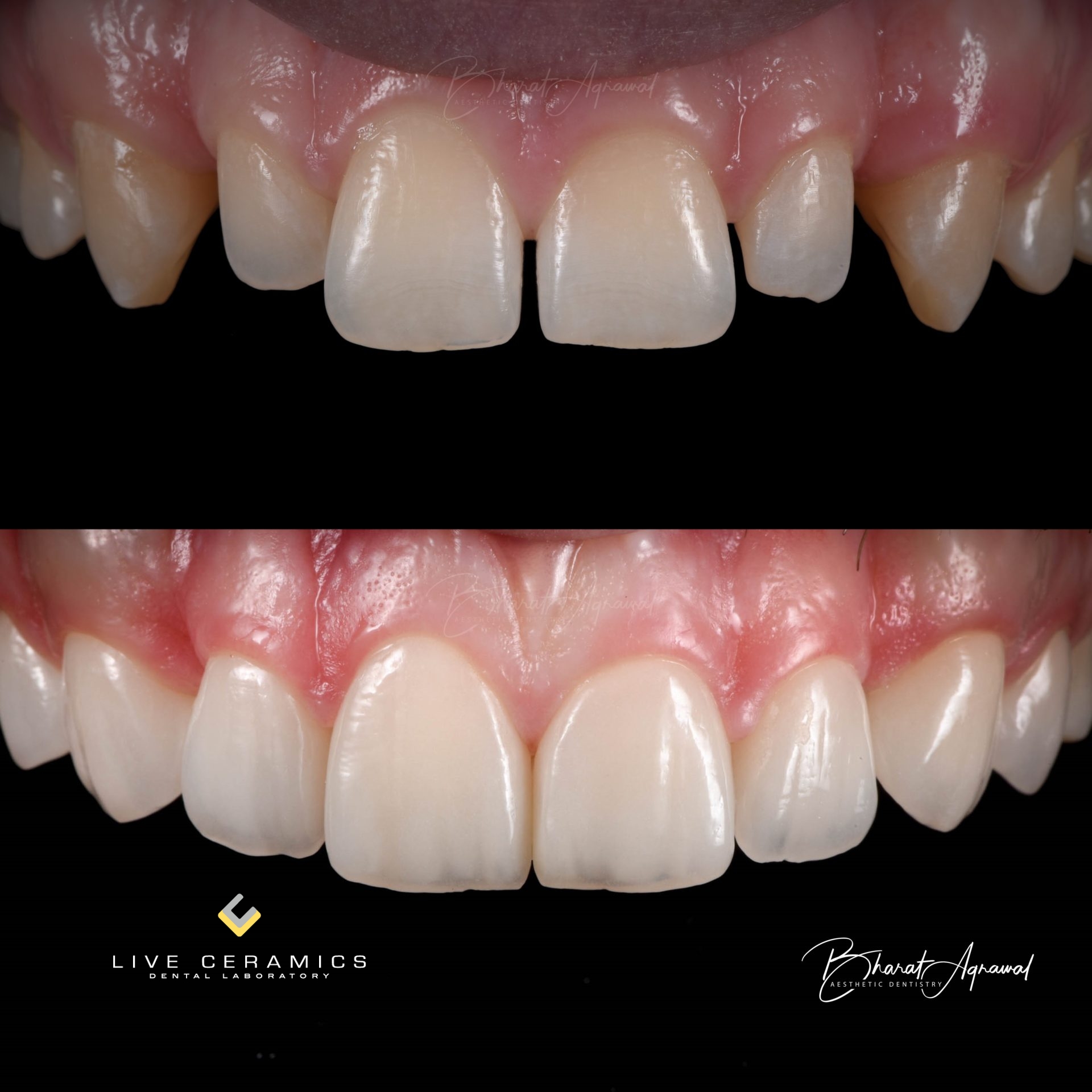 VENEER – Case 3 – Live Ceramics