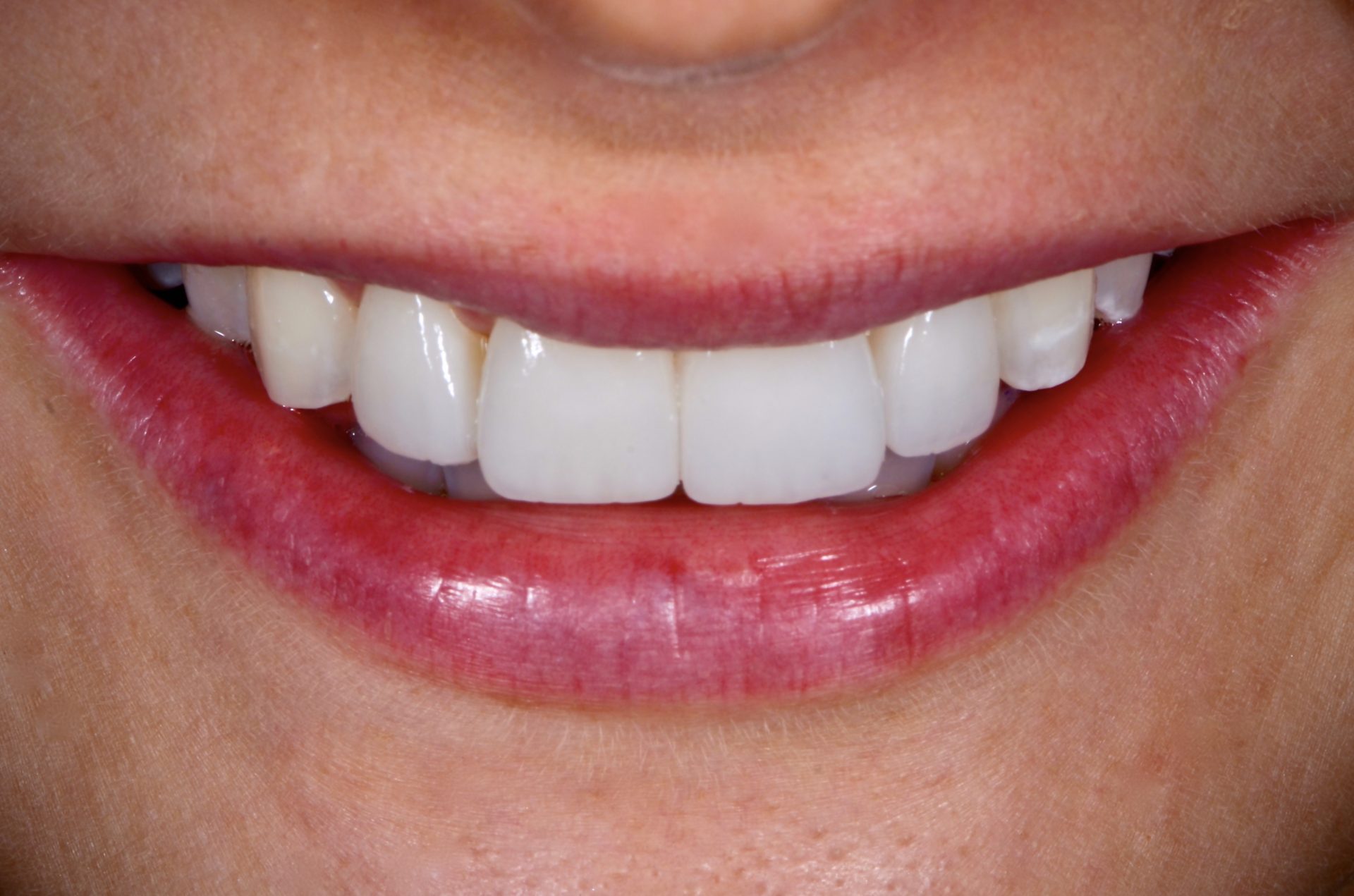 VENEER – Case 1 – Live Ceramics